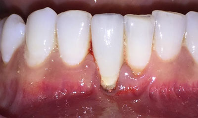 Recession & Root Coverage - Charlton Dentistry