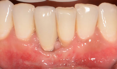 Recession & Root Coverage - Charlton Dentistry