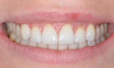 Recession & Root Coverage - Charlton Dentistry