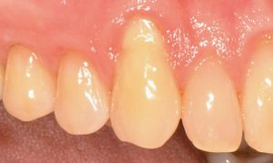 Recession & Root Coverage - Charlton Dentistry