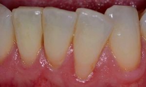 Recession & Root Coverage - Charlton Dentistry
