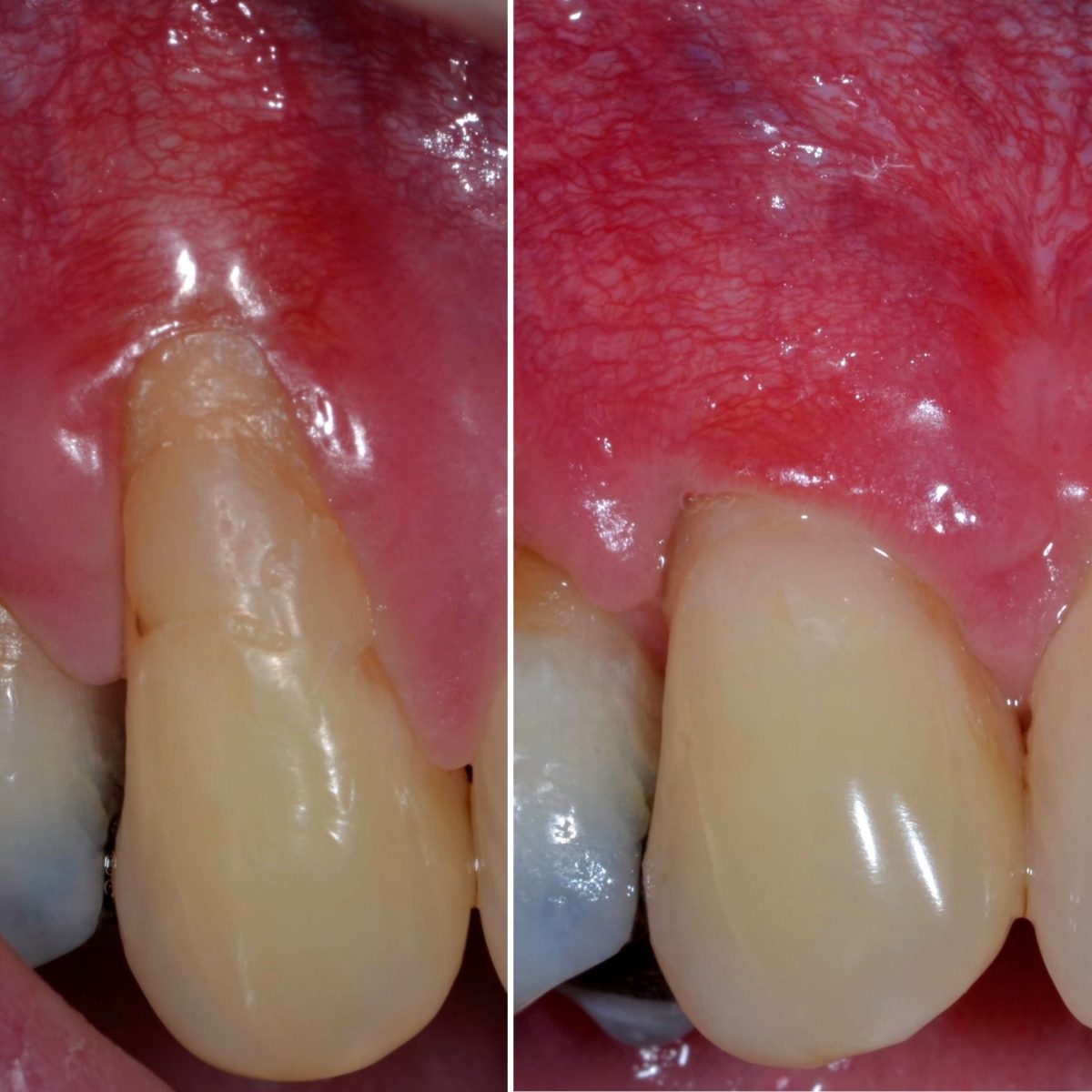 Recession & Root Coverage - Charlton Dentistry
